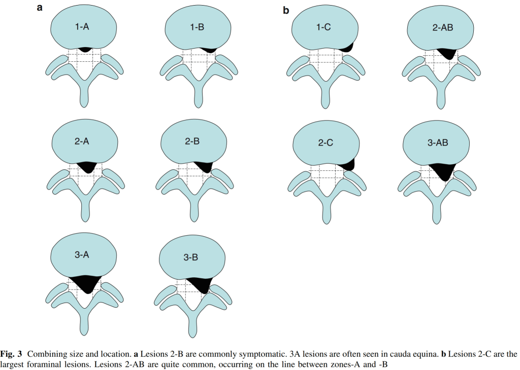 What is a herniated disc? – The Scandi Physio