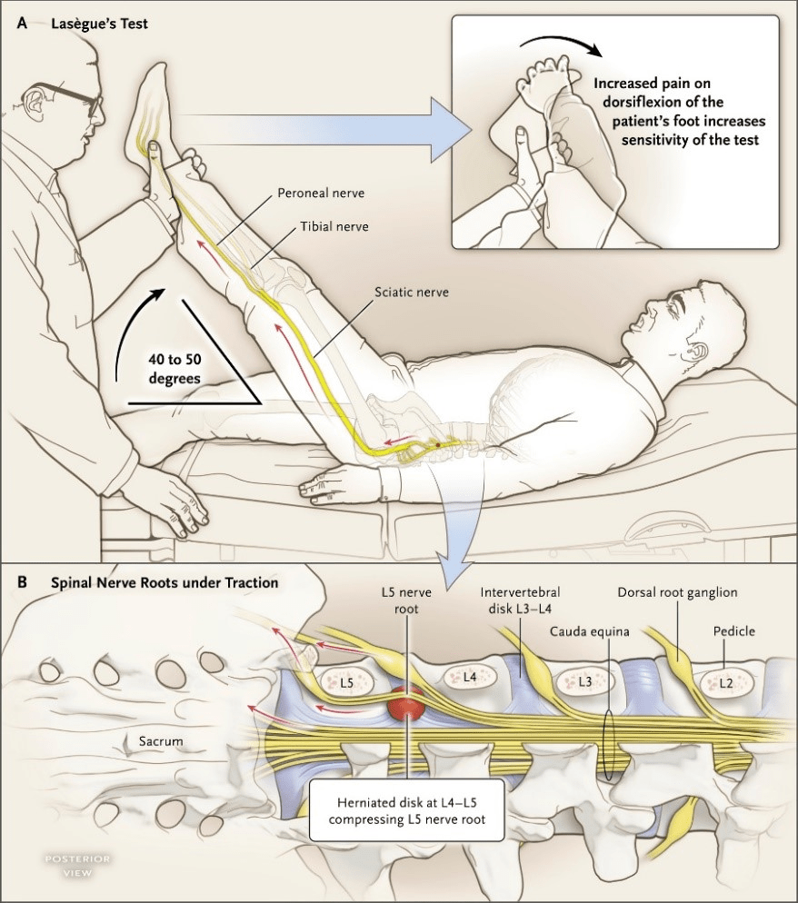 Neurodynamic tests – part 2: Lasegue, slump, n. femoralis – The Scandi ...