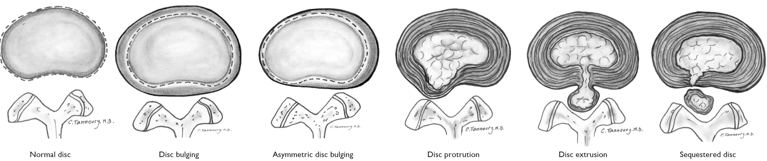 Are disc herniations painful? – The Scandi Physio