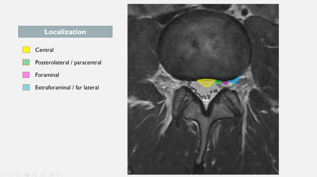 Are disc herniations painful? – The Scandi Physio