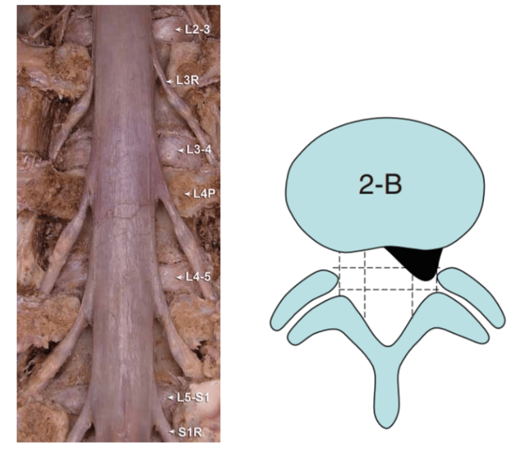 Are disc herniations painful? – The Scandi Physio