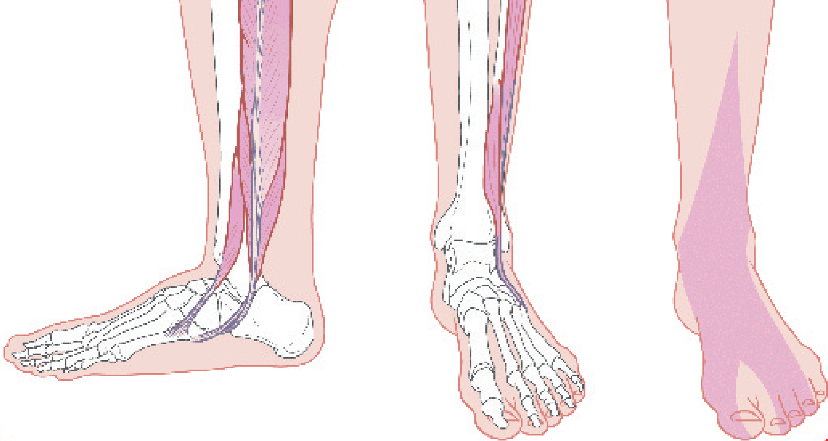 Foot drop: Fibular (peroneal) neuropathy VS L5 radiculopathy – The ...